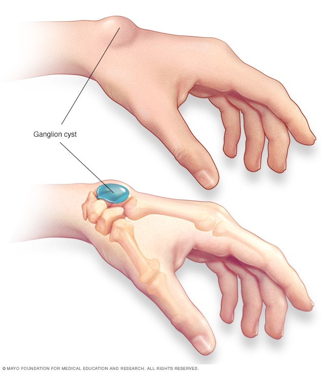 Ganglion Zyste